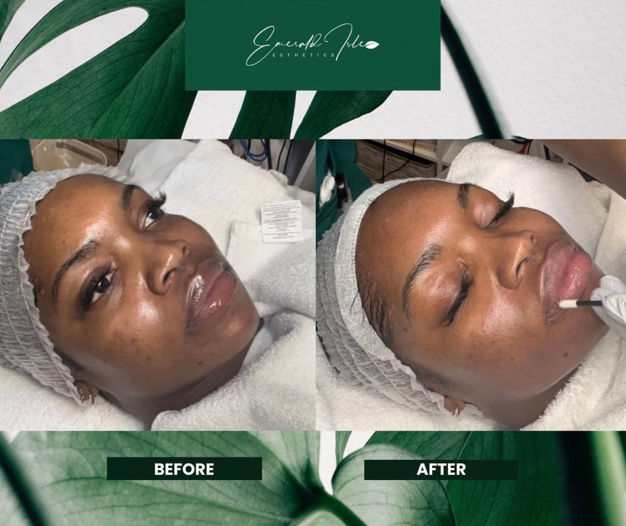 EMERALD BIO PEEL (Face Application Only) AT HOME PEEL – Emerald Isle ...